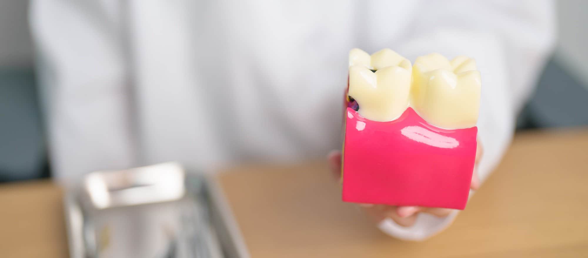 Identifying and Treating Cracked Tooth Syndrome in Mason | Dr. Lance